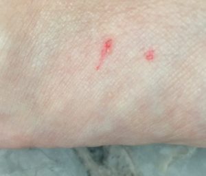 Snakebite Symptoms | Symptom Information | Thailand Snakes