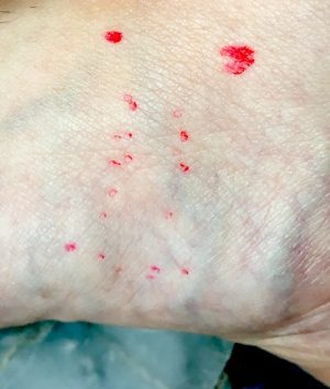 Snakebite Symptoms | Symptom Information | Thailand Snakes